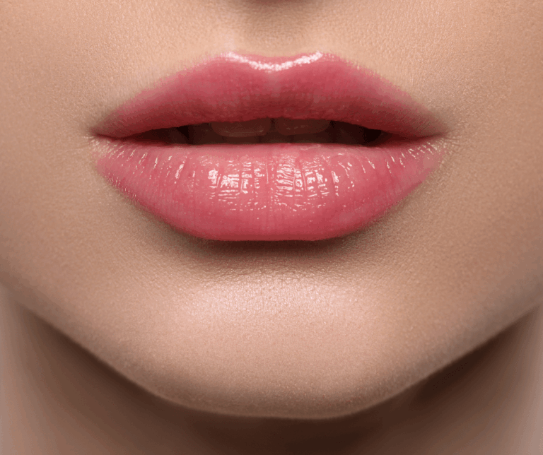 Labios hinchados por ácido hialurónico | Causas y soluciones